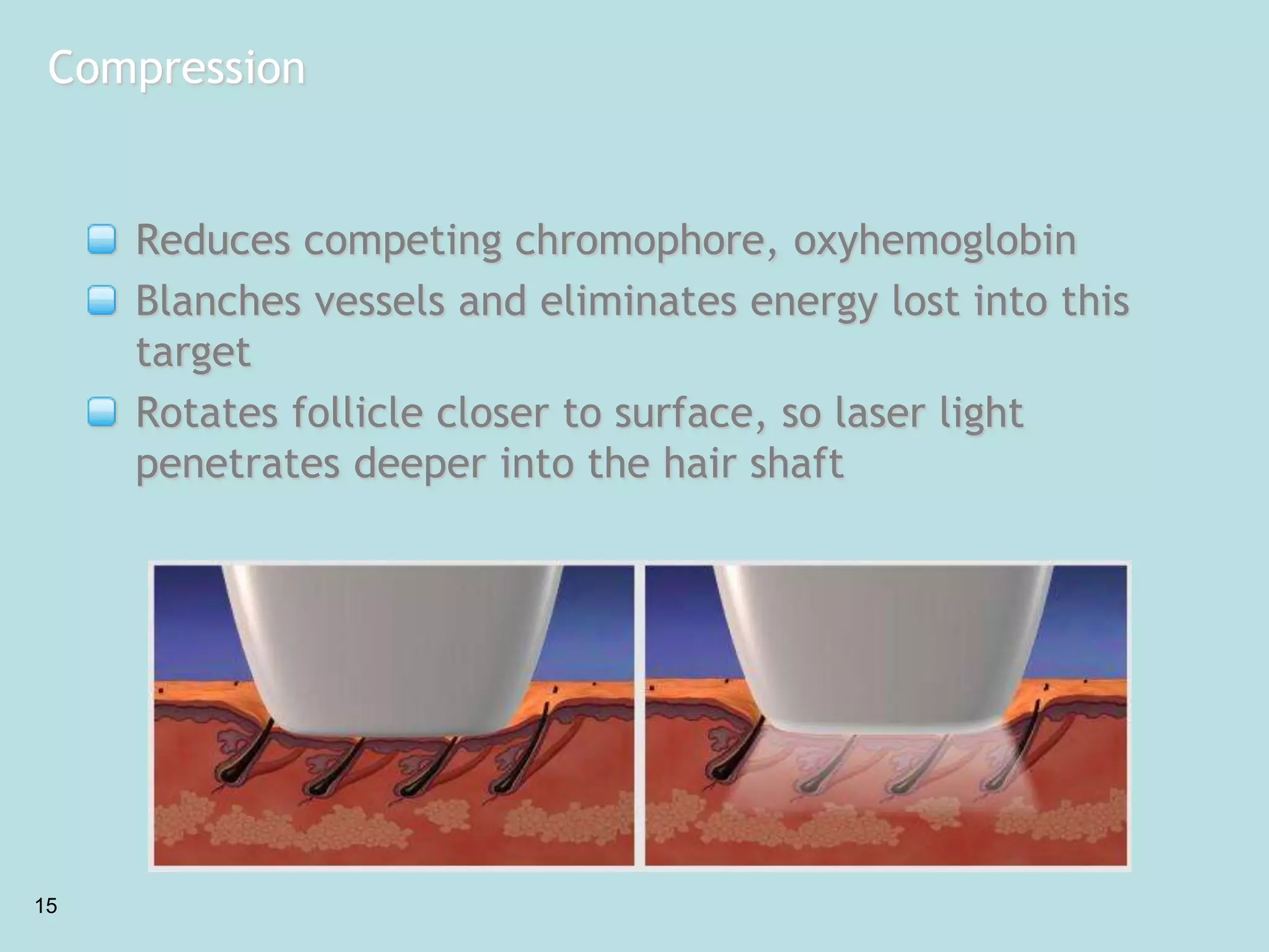 Nd yag laser hair reduction | PPT