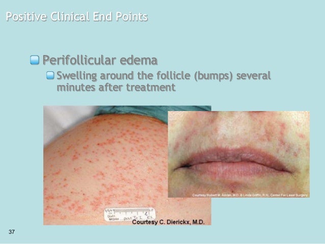 Nd yag laser hair reduction