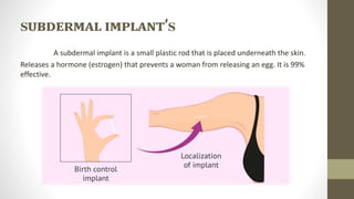 Implants as an novel drug delivery. | PPTX | Ear, Nose and Throat ...
