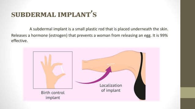 Implants as an novel drug delivery. | PPT