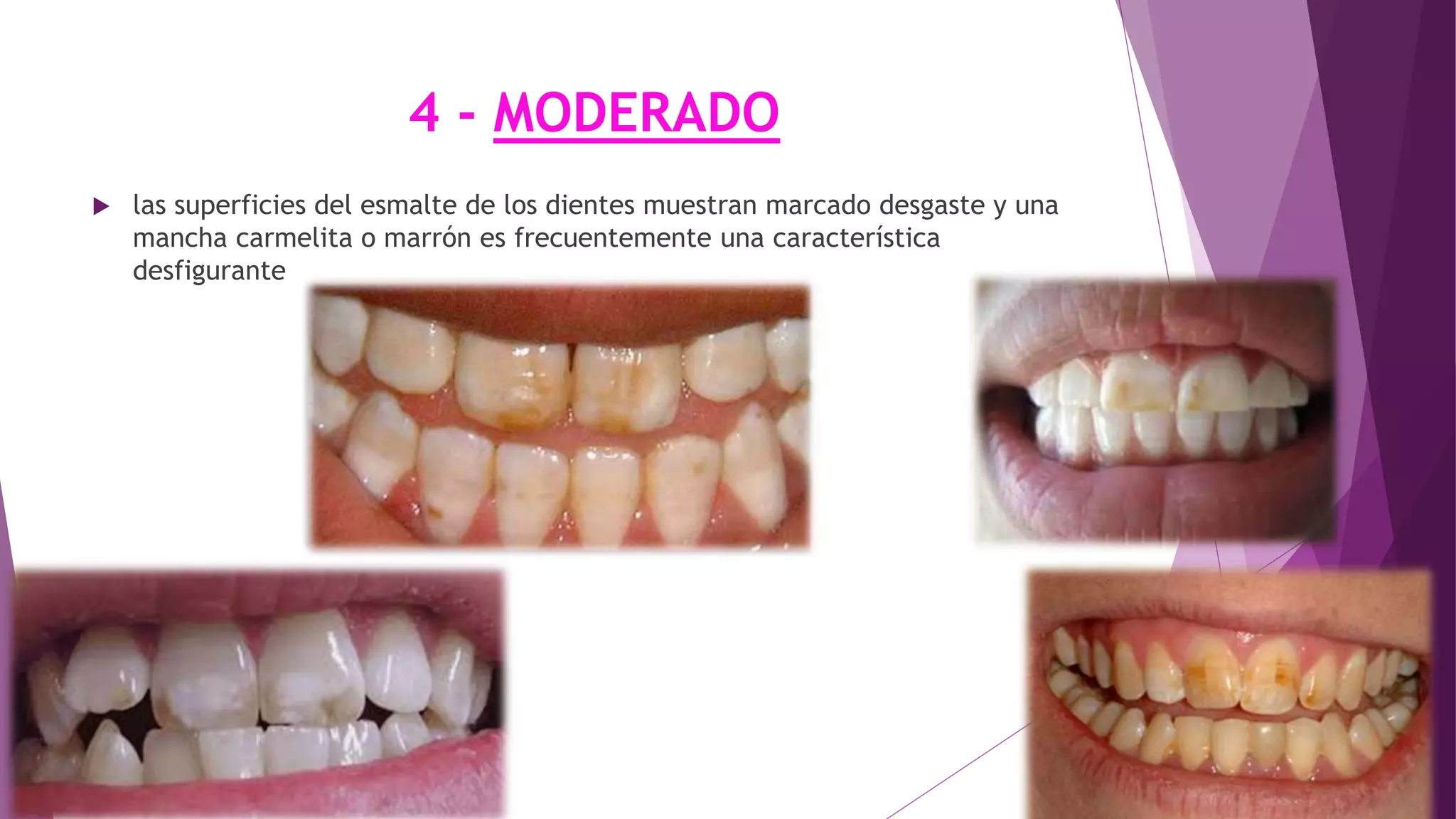 Indice de Dean. Fluorosis dental | PPTX