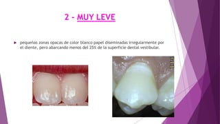 Indice de Dean. Fluorosis dental | PPTX