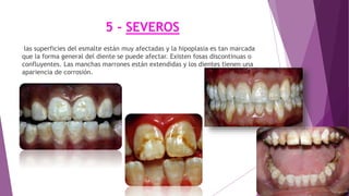 Indice de Dean. Fluorosis dental | PPTX