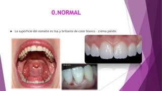Indice de Dean. Fluorosis dental | PPTX