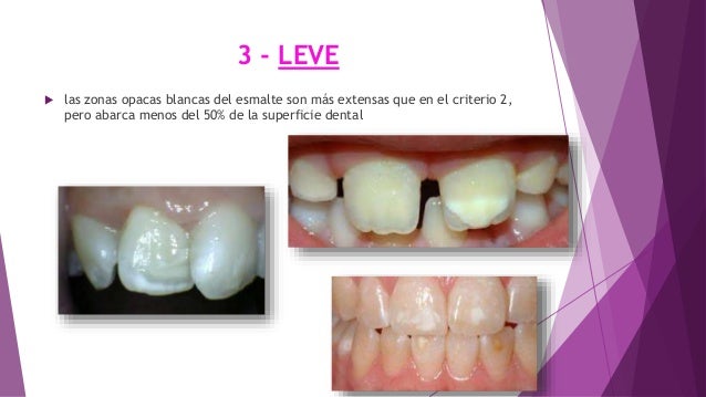 Indice de Dean. Fluorosis dental