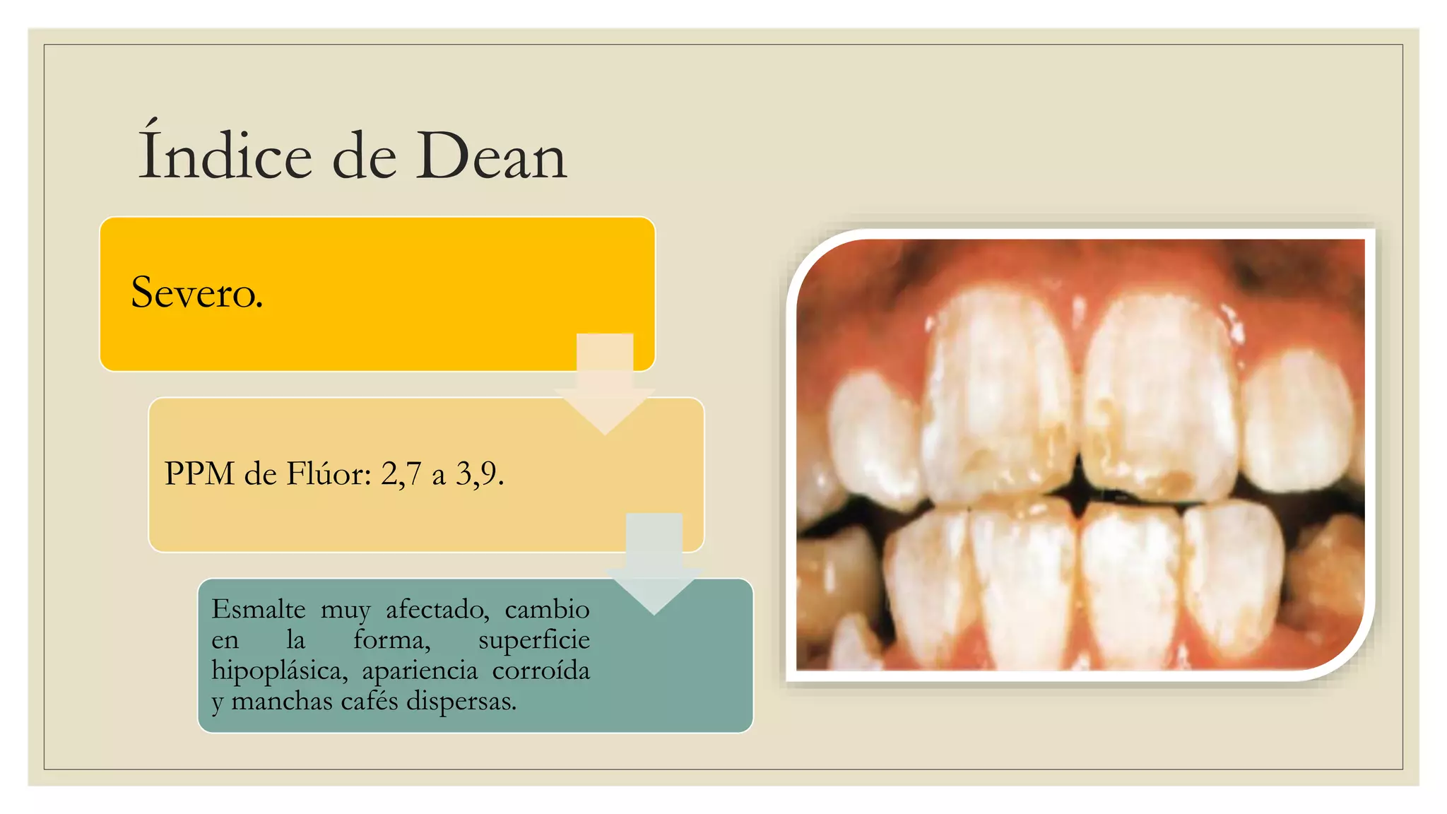 Indices de deán, índices de fluorosis por superficie dentales | PPTX