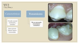 Indices de deán, índices de fluorosis por superficie dentales | PPTX