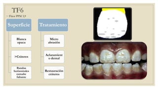 Indices de deán, índices de fluorosis por superficie dentales | PPTX