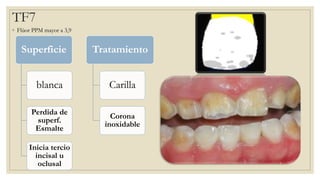 Indices de deán, índices de fluorosis por superficie dentales | PPTX