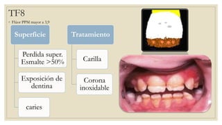 Indices de deán, índices de fluorosis por superficie dentales | PPTX