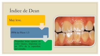 Indices de deán, índices de fluorosis por superficie dentales | PPTX