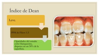 Indices de deán, índices de fluorosis por superficie dentales | PPTX