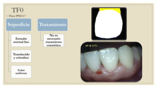 Indices de deán, índices de fluorosis por superficie dentales | PPTX