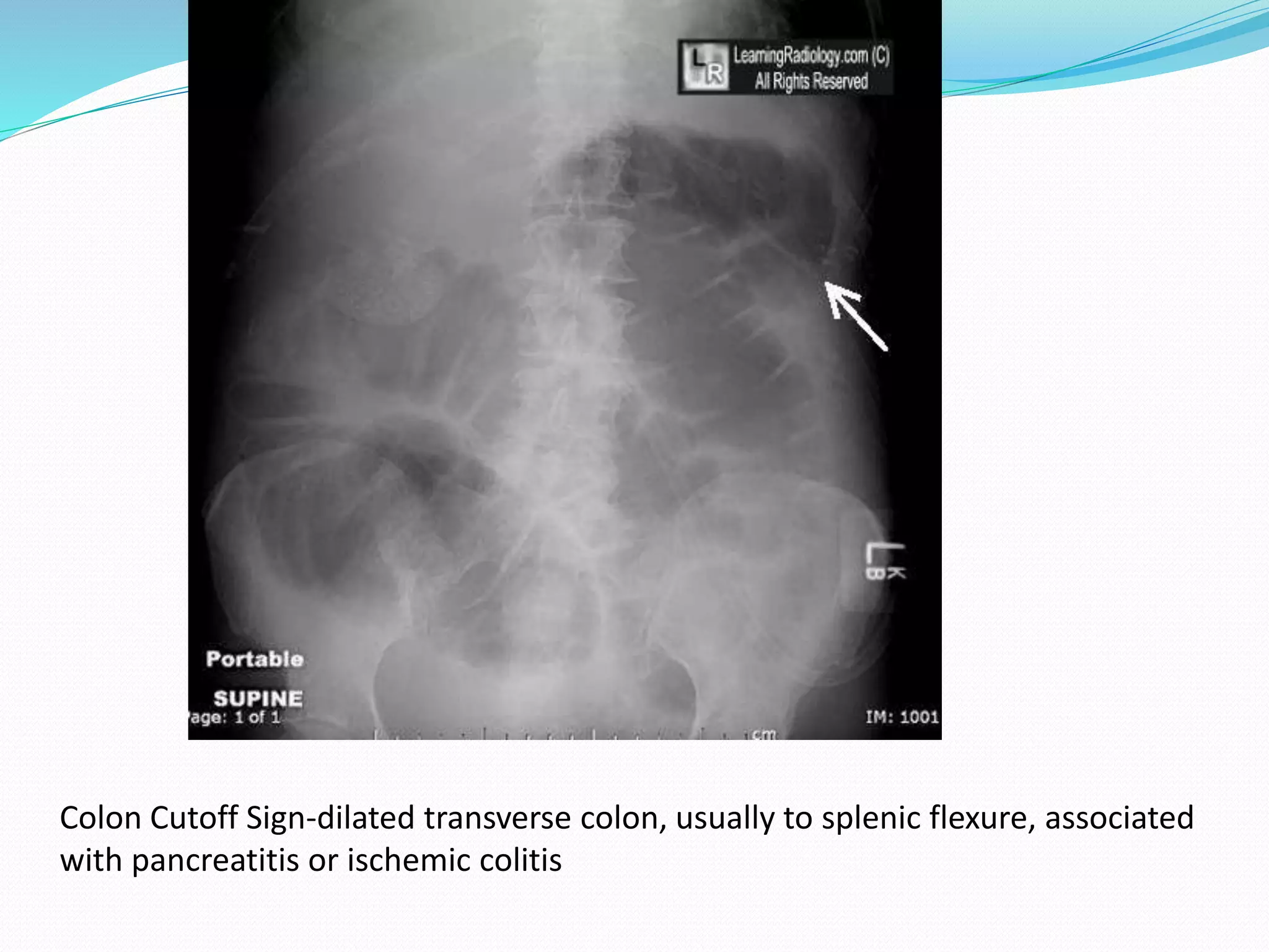 Acute abdomen | PPTX
