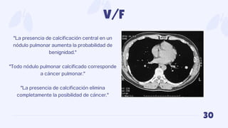 Comprehensive Overview of Pulmonary Nodules: Diagnosis and Risk Factors ...