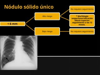 Nódulo Pulmonar en Tomografía - Aspectos Principales.pptx