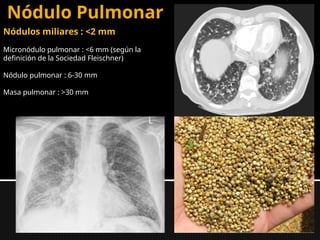 Nódulo Pulmonar en Tomografía - Aspectos Principales.pptx