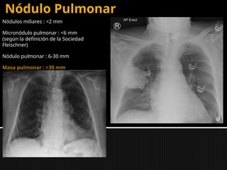 Nódulo Pulmonar en Tomografía - Aspectos Principales.pptx