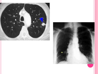 Nódulo pulmonar solitario | PPTX