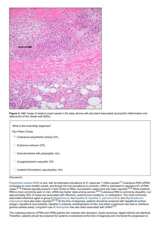 Nódulos dolorosos y persistentes en las extremidades inferiores.pdf