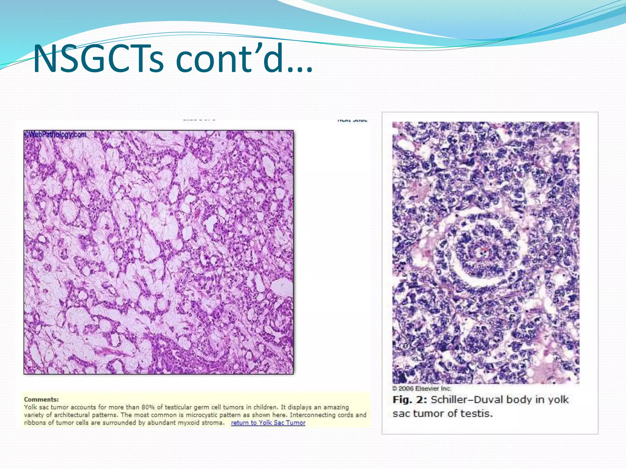 Pathology of testicular tumors | PPTX