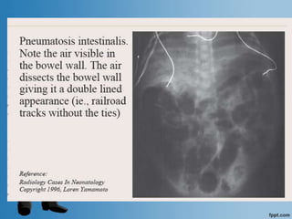 Pneumatosis Intestinalis Necrotizing Enterocolitis