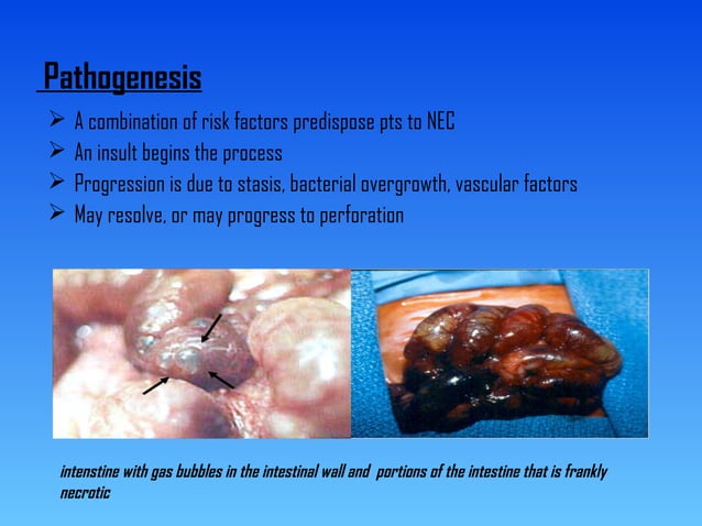 Necrotizing enterocolitis | PPT | Digestive Disorders | Diseases and ...