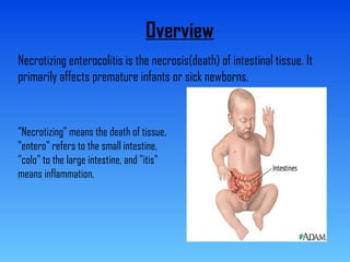 Necrotizing enterocolitis | PPT