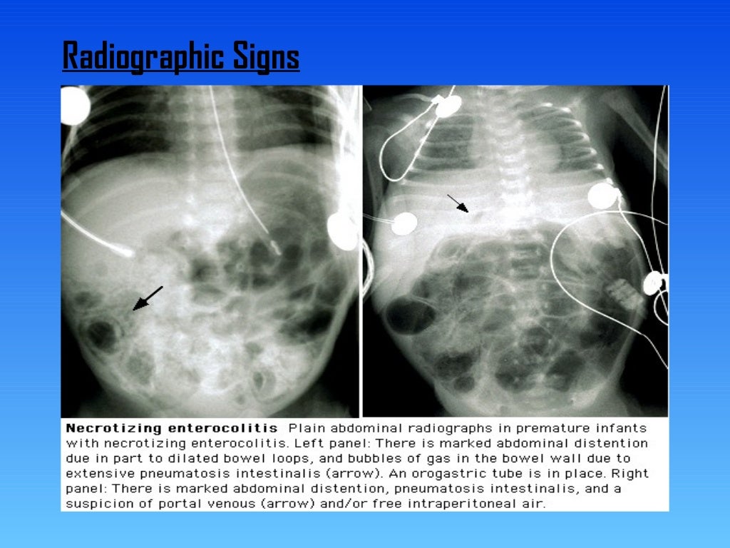 Necrotizing enterocolitis