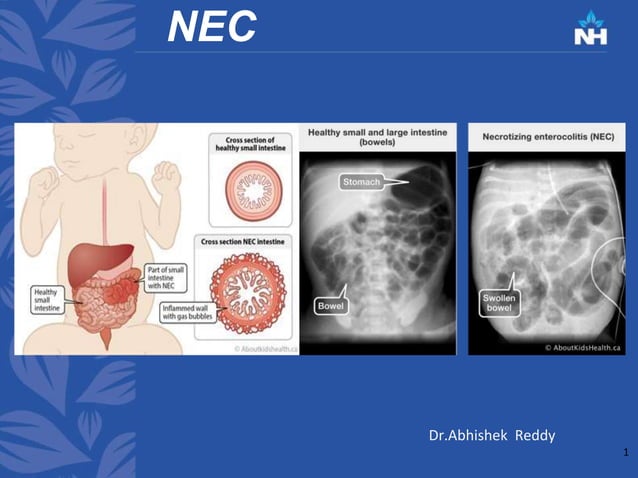 Necrotizing enterocolitis(NEC) | PPTX | Digestive Disorders | Diseases ...