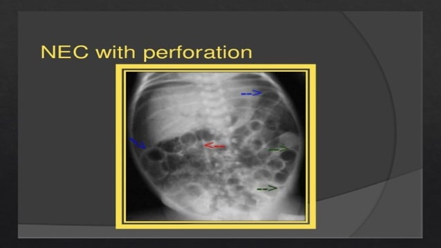 Necrotizing enterocolitis in new born babies | PPT