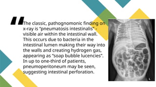 Neonatal Enterocolitis and its causes with treatment. | PPTX
