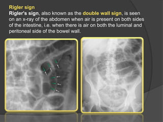 Necrotizing enterocolitis | PPT