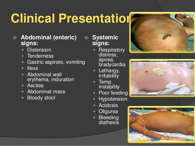 Necrotizing enterocolitis