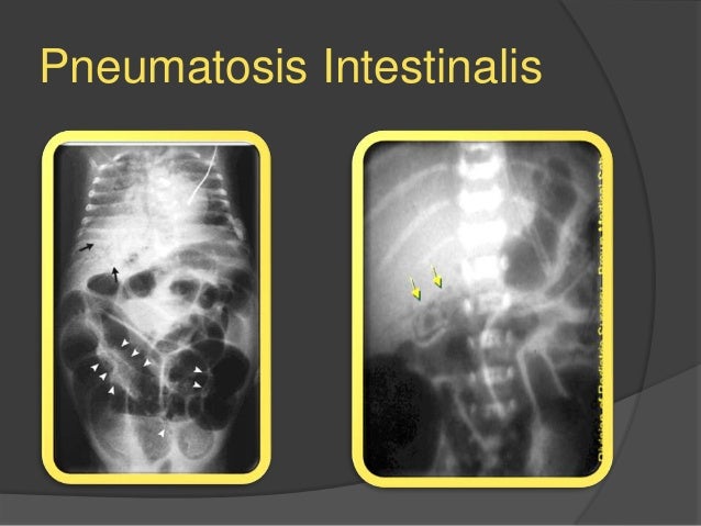 Pneumatosis Intestinalis Necrotizing Enterocolitis