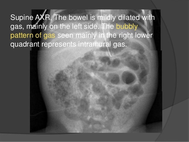 Necrotizing enterocolitis