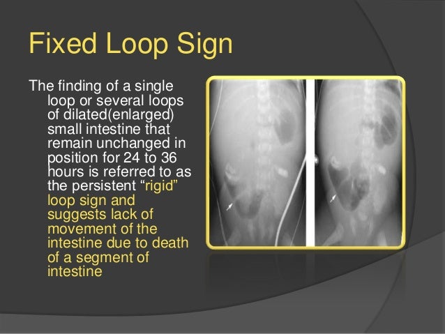 Necrotizing enterocolitis