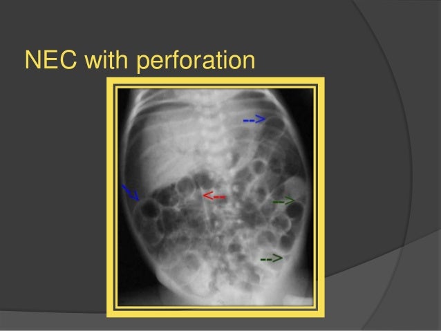 Necrotizing enterocolitis