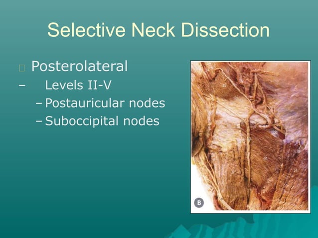 Neck Dissection | PPT