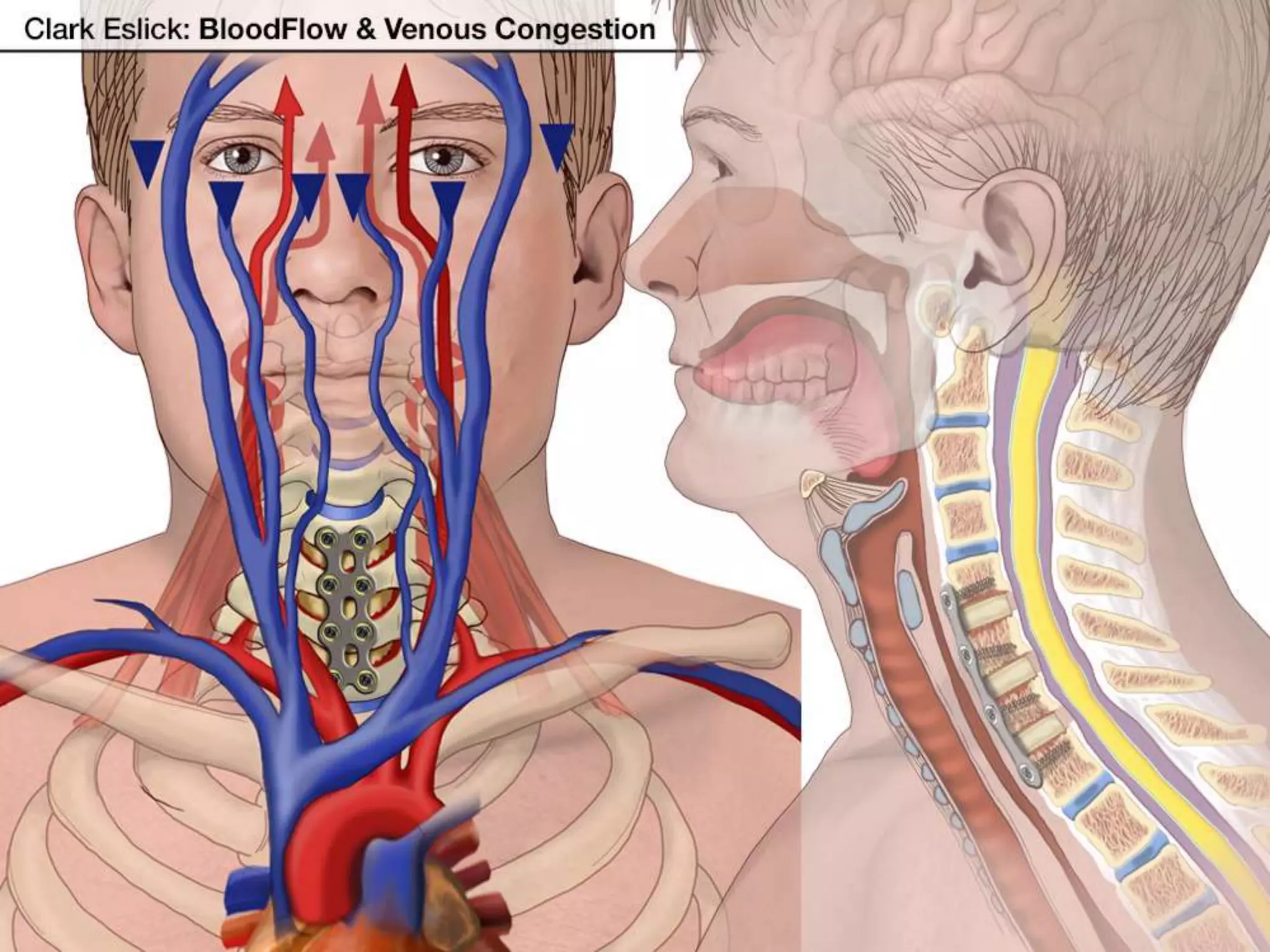 Neck hematoma Venous Congest Blood Flow | PPTX