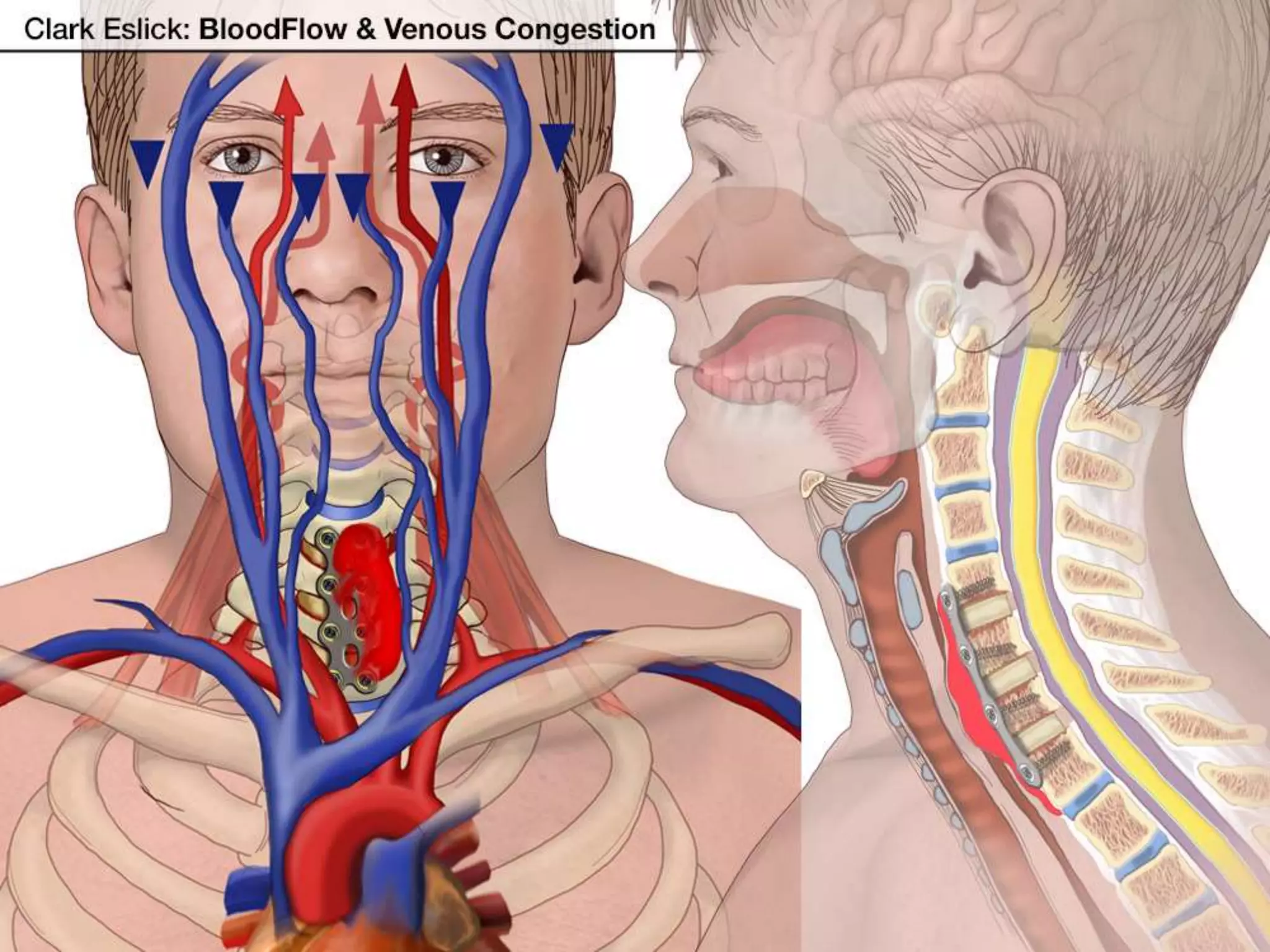 Neck hematoma Venous Congest Blood Flow | PPTX