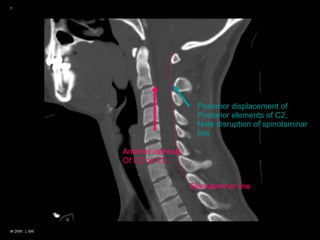 Neck Pain After Trauma | PPT