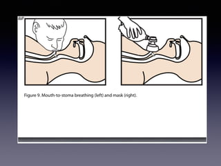 Neck breathers presentation for trainees 2014 | PDF