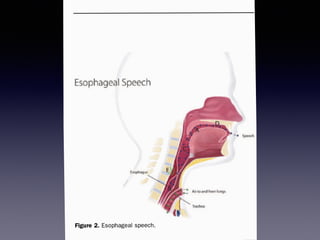 Neck breathers presentation for trainees 2014 | PDF