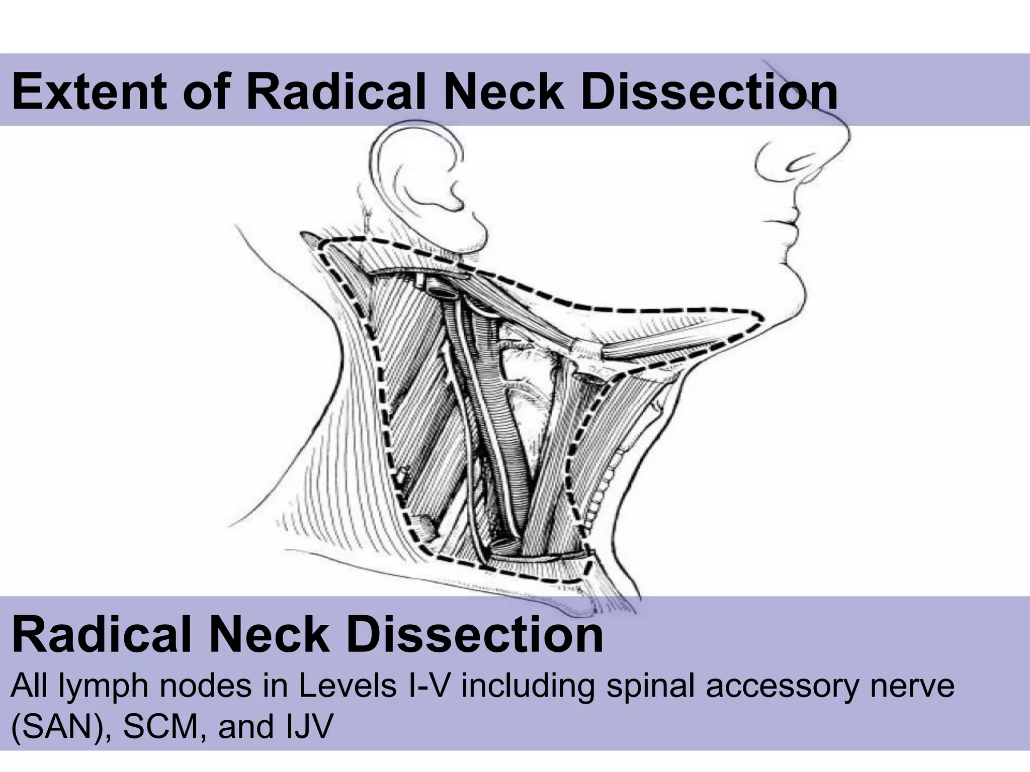 Neck dissection | PPTX