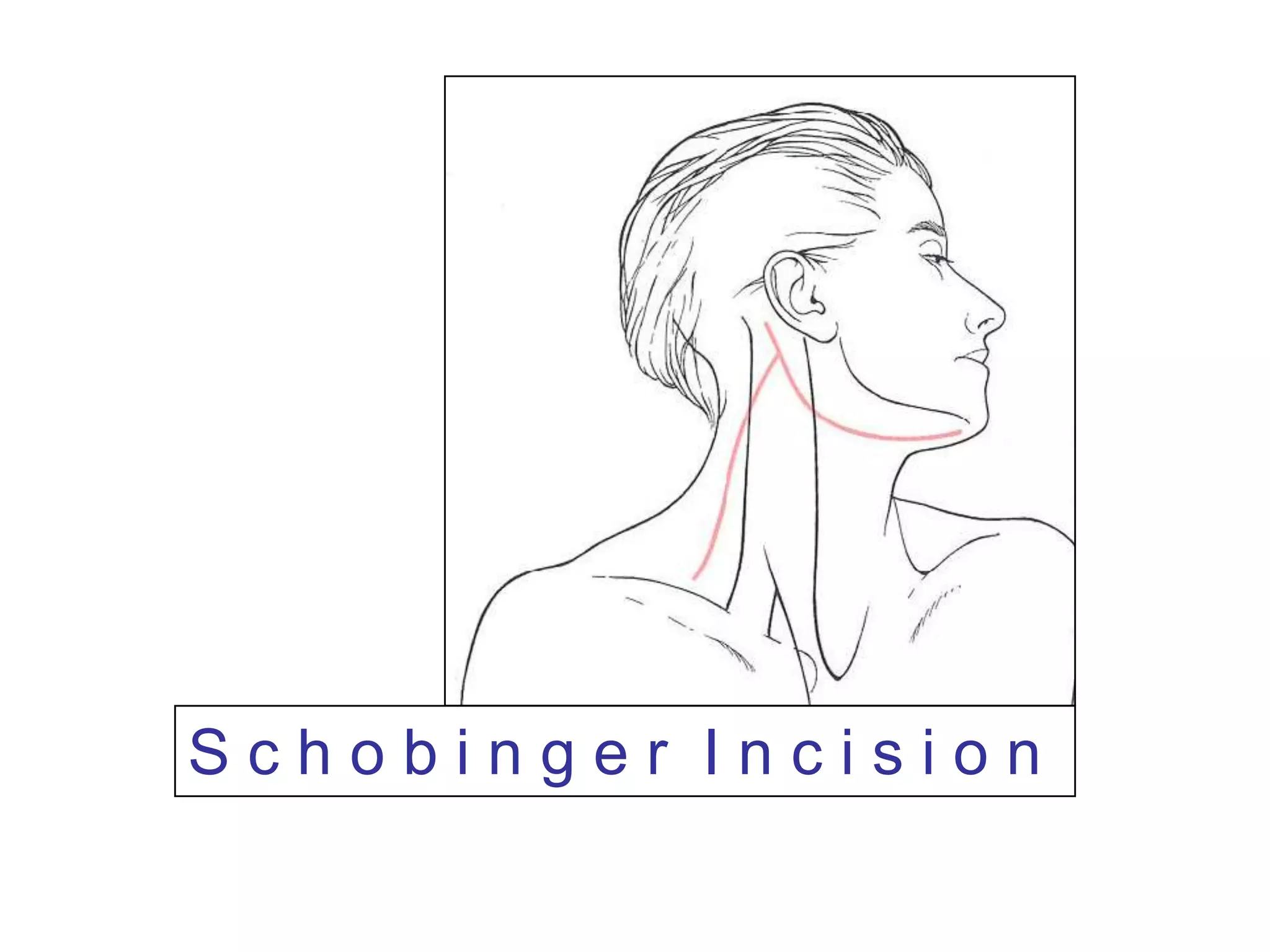 Neck dissection | PPTX