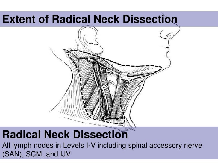 Neck dissection