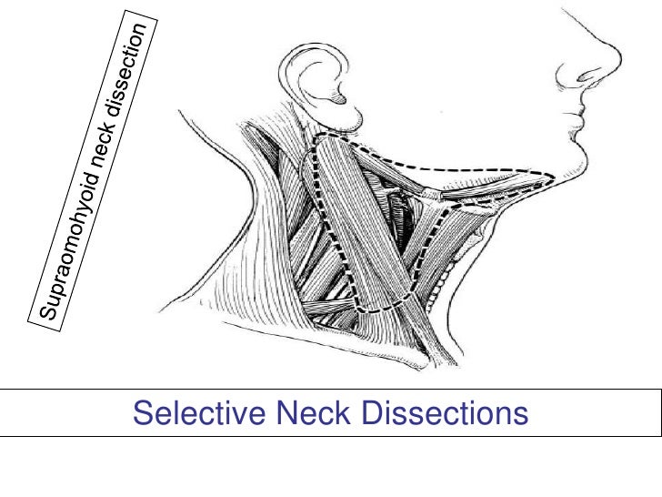 Neck dissection Neck dissection