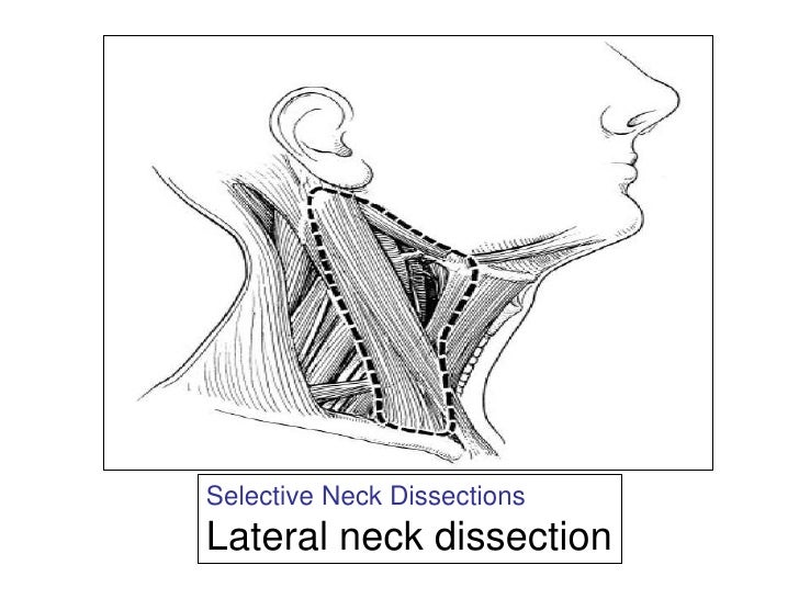 Neck dissection