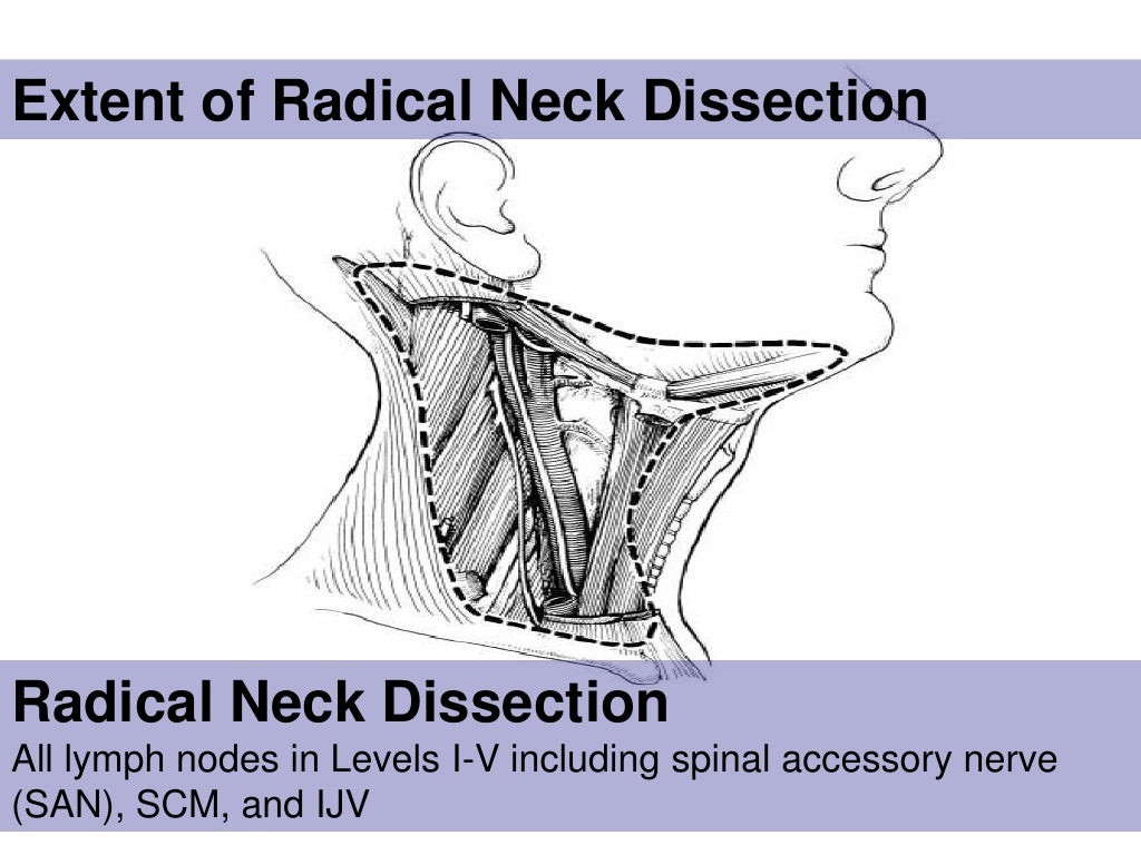 Neck dissection
